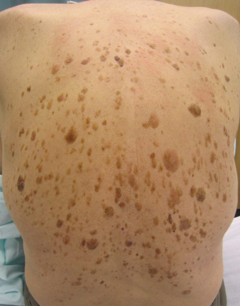 Mole/Lesion Removal - East Midlands Laser Clinic